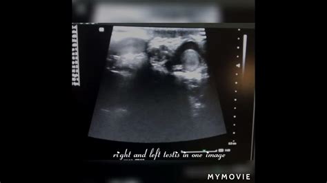 Right Retractile Testis And Left Side Turbid Hydrocele • Ultrasound Case Youtube