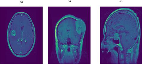 Enhancing Brain Tumor Mri Classification With An Ensemble Of Deep