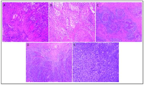 Tumor Regression Grading Trg After Preoperative Chemo Radiotherapy In Download Scientific