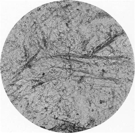 Figure 1 From A Case Of Plexiform Neurofibroma Involving The Orbit Semantic Scholar