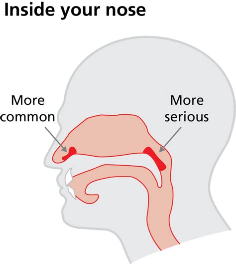 Epistaxis Digital Patient Information Hub