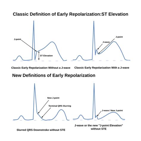 Benign Early Repolarization Wikipedia
