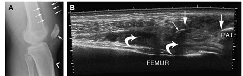 Figure 12 From Ultrasound Of The Knee
