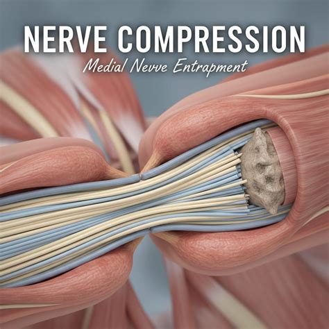 Nerve Compression कारण लक्षण इलाज और रोकथाम