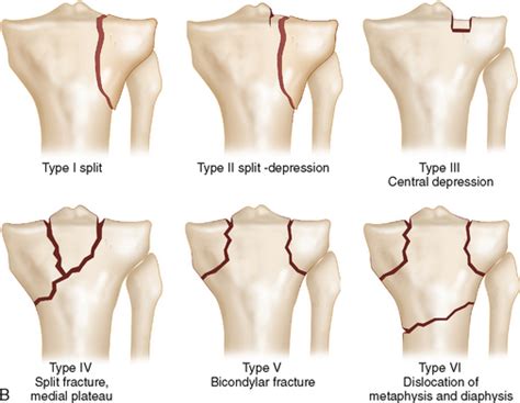 Proximal Tibia Fractures Musculoskeletal Key