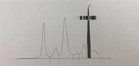 Nonuremic Calciphylaxis In A Patient With Multiple Myeloma A Saudi