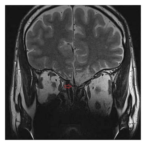 Mri Shows That The Right Olfactory Bulb Red Arrow Became Larger
