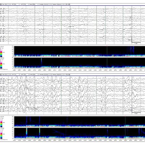 Continuous Electroencephalography EEG Monitoring In The Intensive Download Scientific Diagram