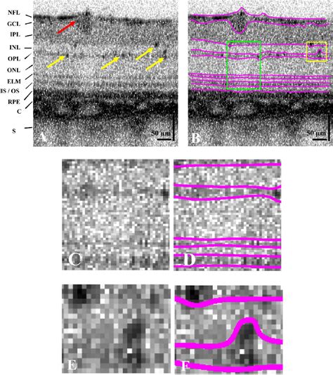 Figure 3 From Intra Retinal Layer Segmentation In Optical Coherence Tomography Images