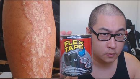 Is Flex Tape Strong Enough For Psoriasis Flakes Youtube