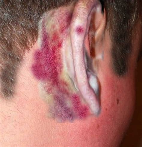 Basilar Skull Fracture Signs And Symptoms
