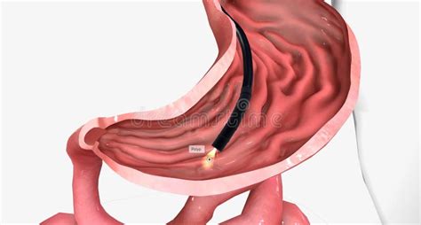 Nurse Endoscopy Stock Illustrations 220 Nurse Endoscopy Stock