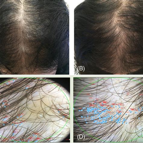 Clinical Pictures Of A 25‐year‐old Female With Fphl Grade I A At Download Scientific Diagram
