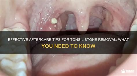 Effective Aftercare Tips For Tonsil Stone Removal What You Need To