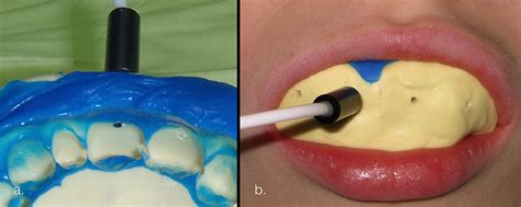 Laser Doppler Flowmetry Evaluation Of The Microcirculation In Dentistry