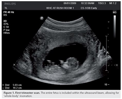Early Pregnancy Ultrasound Early Pregnancy Scan Southampton