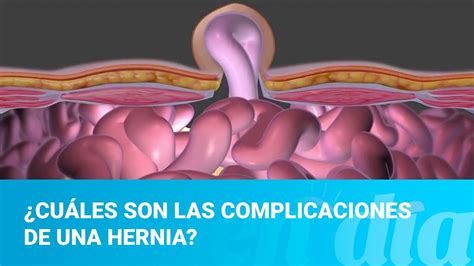 ¿cuáles Son Las Complicaciones De Una Hernia Youtube