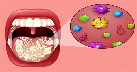 Oral Candidiasis Symptoms