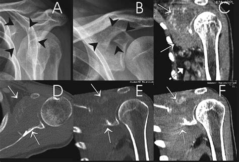 Epithelioid Angiosarcoma Full Article Primary Thyroid Angiosarcoma