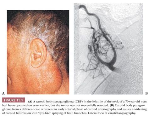 Paragangliomas Basicmedical Key
