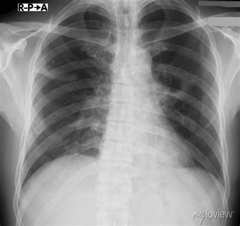 Chest X Ray Image Of Lung Abscess Canvas Prints For The Wall • Canvas