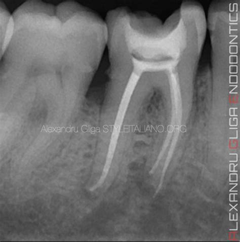 Primary Root Canal Treatment Of Lr6 Using The Mg3 Blue System From