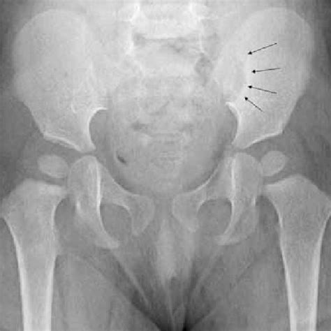 Same Patient As Figure 5 Ct Scan Showed Presence Of A Sequestrum A