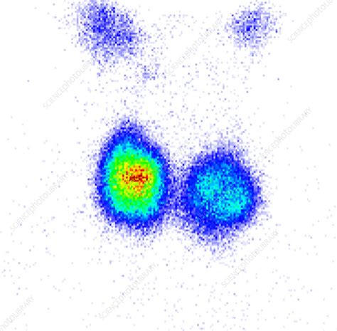 Thyroid Adenoma Scintigram Stock Image C0071653 Science Photo