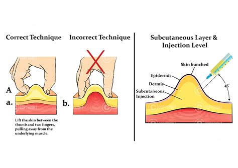 Subcutaneous Injection Technique Fat Dissolving Botox And Filler