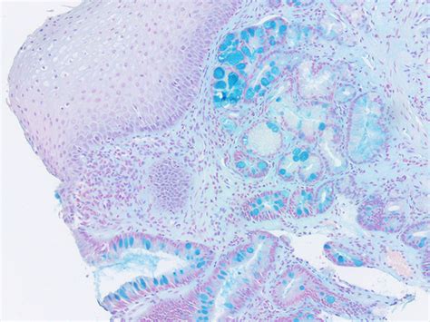 Barretts Esophagus Histology Vs Normal At Tia Curtis Blog