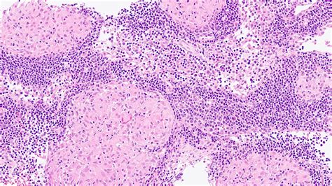 Pathology Outlines Tuberculosis