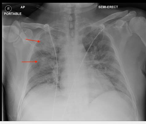 Chest X Ray Demonstrating Patchy Consolidative Opacities Affecting The Download Scientific