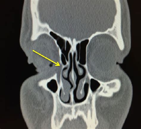 Bilateral Concha Bullosa Download Scientific Diagram