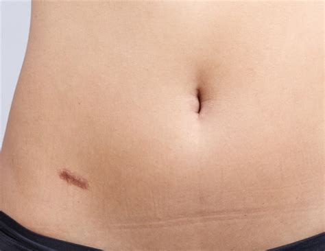 Appendix Removal Scar