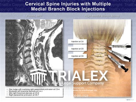 Cervical Spine Injuries With Multiple Medial Branch Block Injection