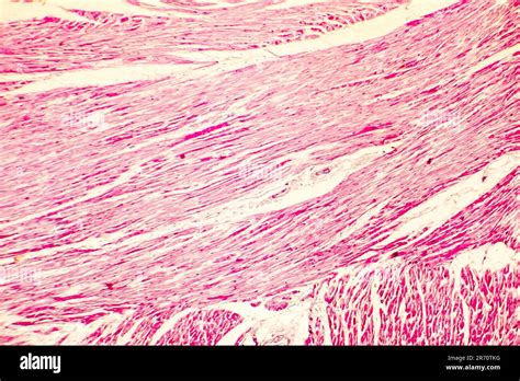 Heart Hypertrophy Photomicrograph Showing Hypertrophic Myocardium With