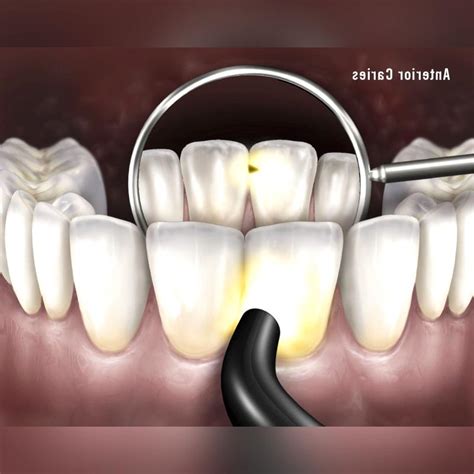Durable Transillumination Caries Detector Sale Or Rent Near Me