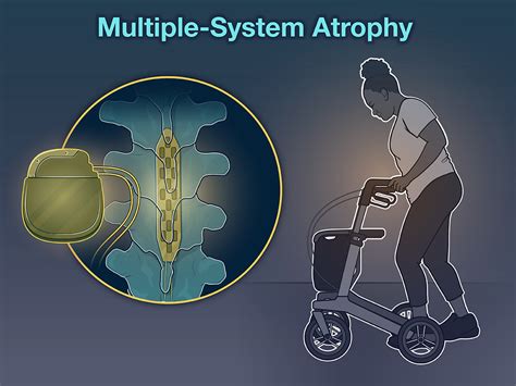 Implanted Neurostimulator In Multiple System Atrophy Patients With Multiple System Atrophy