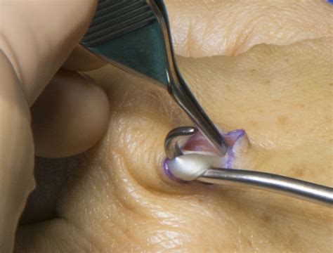 Technique Eip To Epl Tendon Transfer Luanmd Technique Eip To Epl Tendon Transfer Luanmd