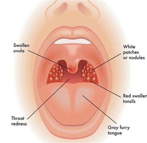 Best Tonsillitis Treatment In Miyapur Hyderabad