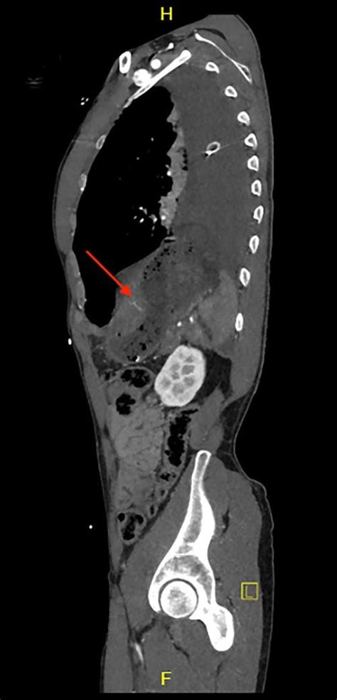 Sagittal View Of Ct Scan Demonstrates A Level Of The Left Hemidiaphragm