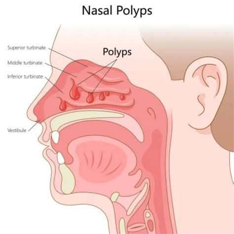 Peruse This Primer For Nasal Polyp Removal Coding Precision