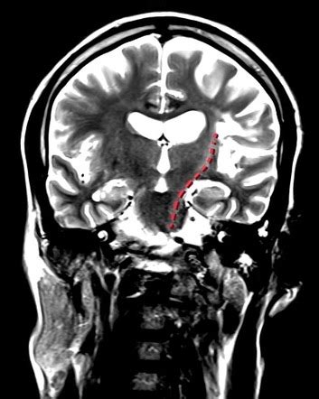 Corticospinal Tract Mri