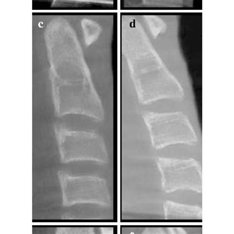 Pdf Comparative Determination Of Skeletal Maturity By Handwrist