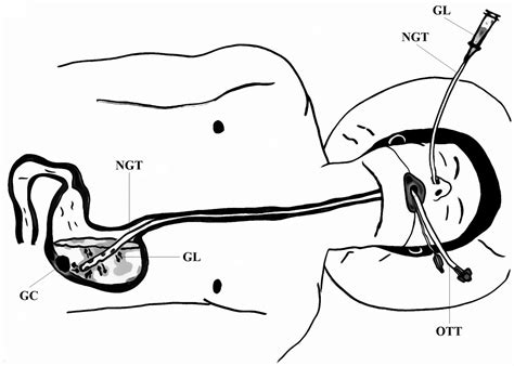 Figure 1 Utility Of Nasogastric Tube For Medical And Surgical