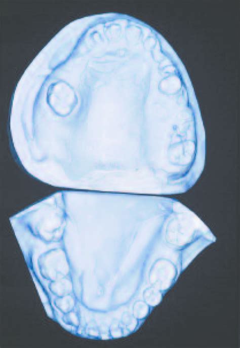 What Is Master Cast In Dental At Samuel Arteaga Blog