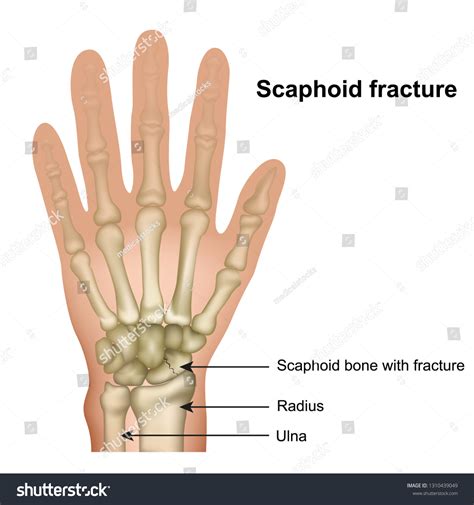 Scaphoid Fossa Wrist