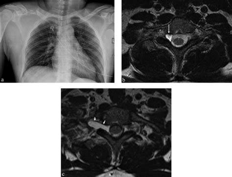 Scapulothoracic Dissociation Pmc