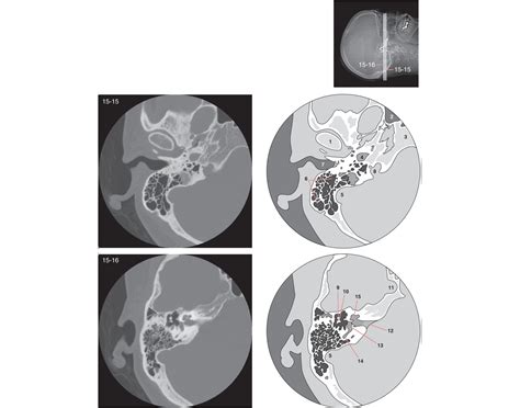 Ct Temporal Bones 03 Axial Quiz