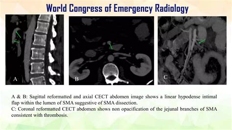 Spontaneous Sma Dissection An Unusual Cause Of Intestinal Obstruction Pptx